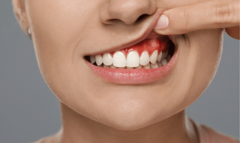 Preventing and Treating Gum Disease